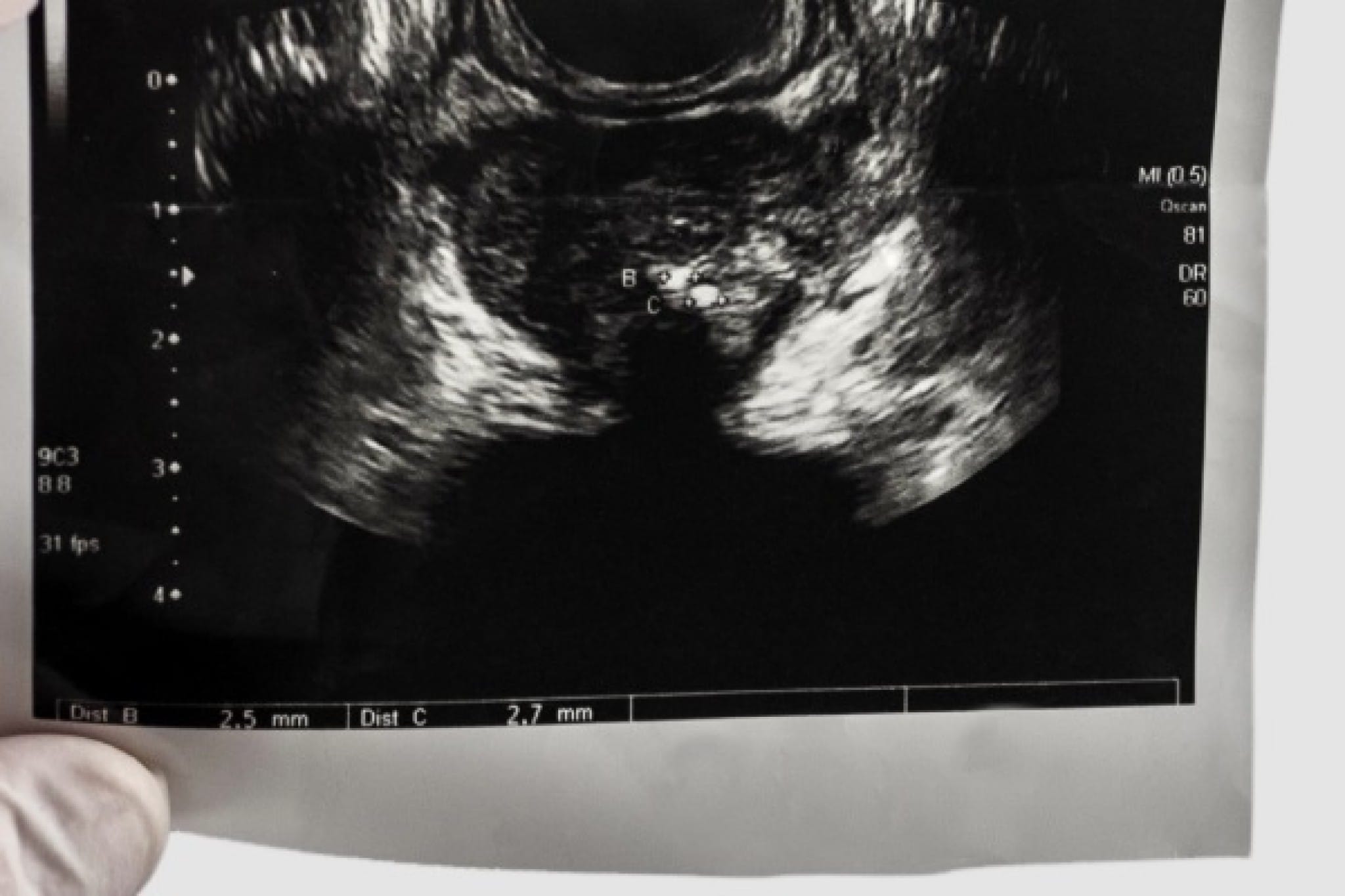 Ultrassonografia pode diagnosticar câncer de próstata – tech4health t4h ...