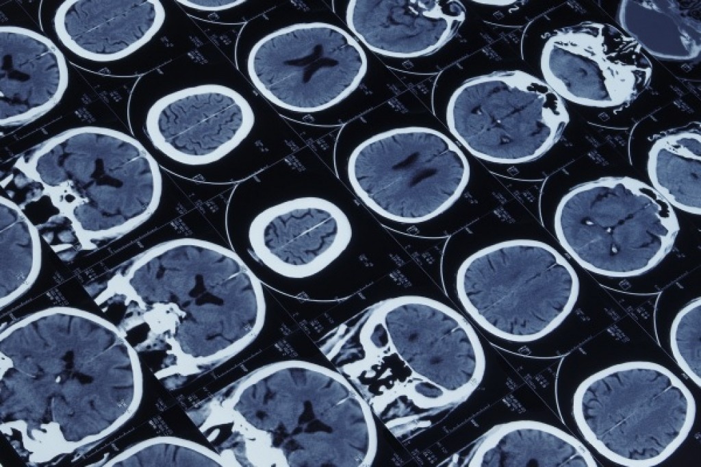 Cientistas mapeiam o rápido crescimento e o lento declínio do cérebro ...